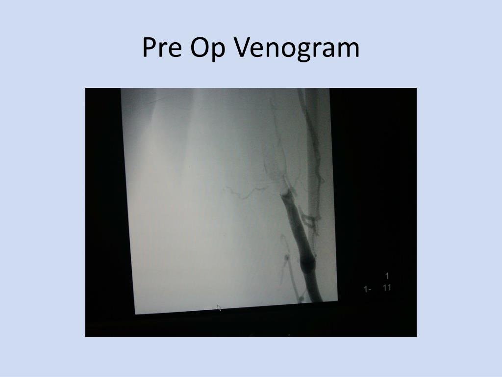 PPT - Endovascular Treatment for Patients with Deep Vein Thrombosis ...