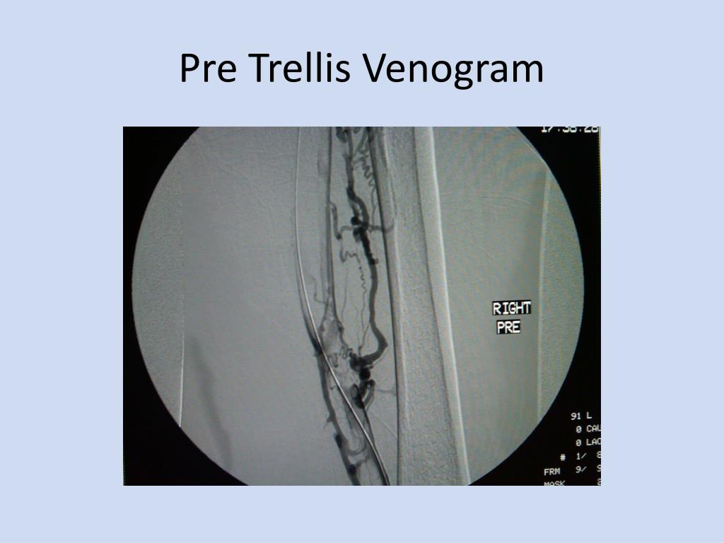 PPT - Endovascular Treatment for Patients with Deep Vein Thrombosis ...