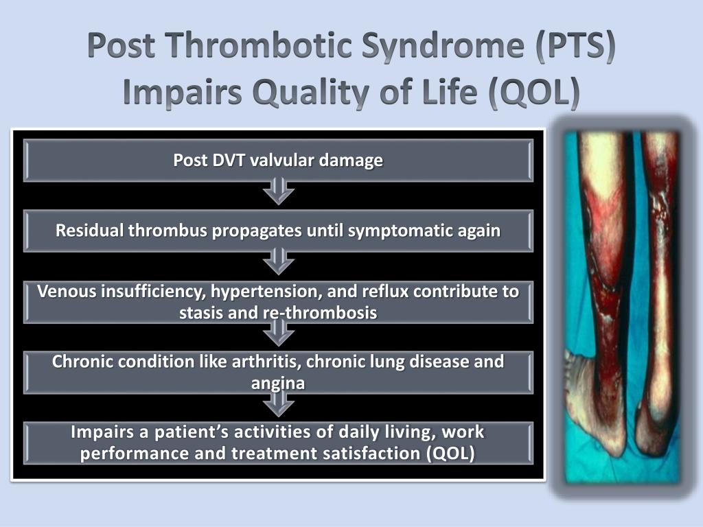 PPT - Endovascular Treatment for Patients with Deep Vein Thrombosis ...