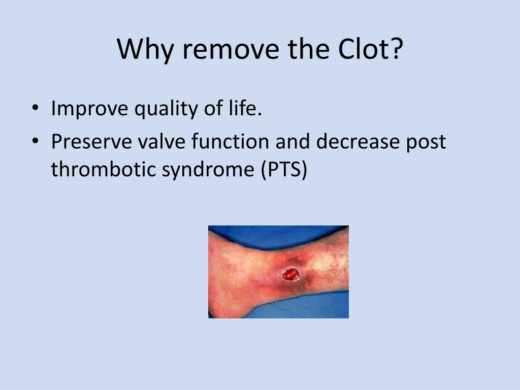 PPT - Endovascular Treatment for Patients with Deep Vein Thrombosis ...