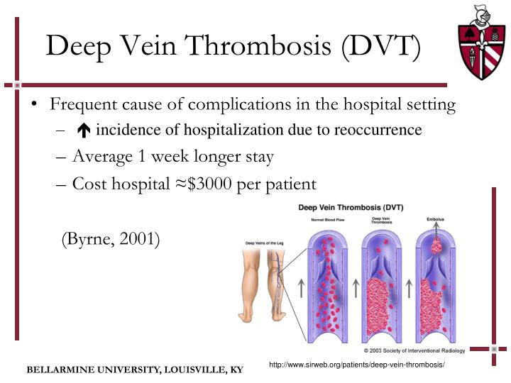 PPT - Compression Devices and Incidence of Deep Vein Thrombosis in Post ...