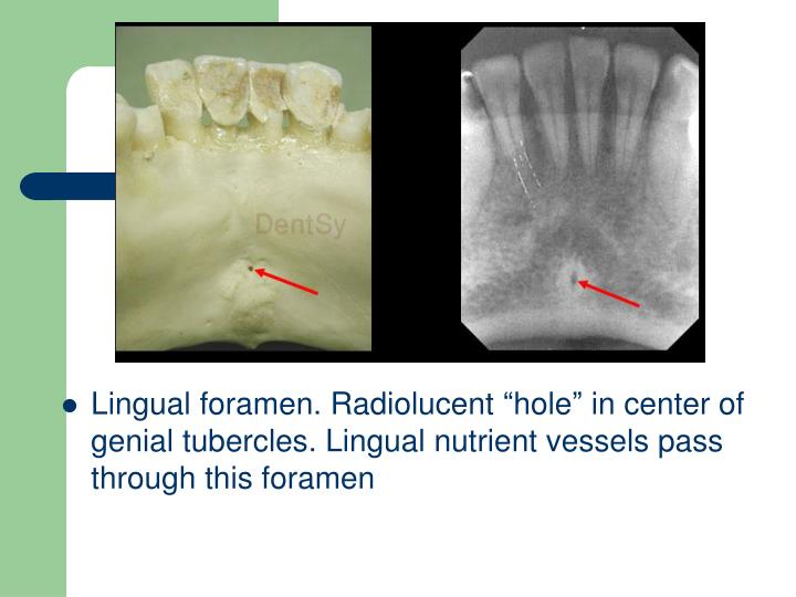 Lingual Foramen Radiology