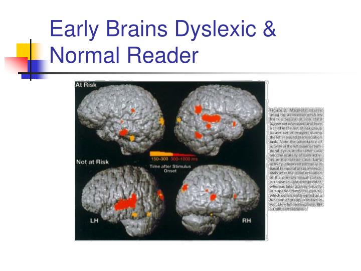 PPT - DYSLEXIA and the BRAIN PowerPoint Presentation - ID:3420845