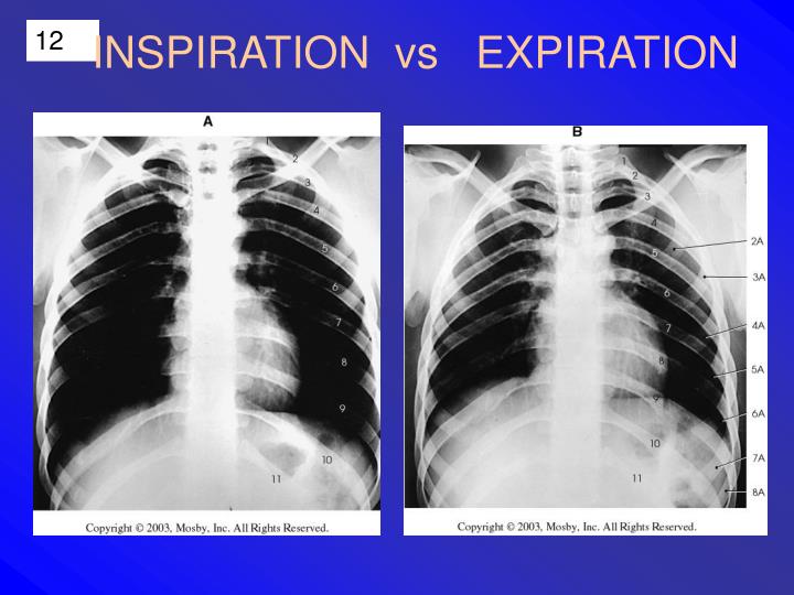 PPT - PA -anterior side BEST SEEN AP -posterior side BEST SEEN ...