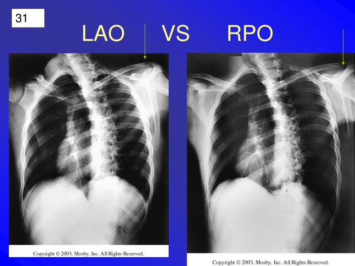 PPT - PA -anterior side BEST SEEN AP -posterior side BEST SEEN ...