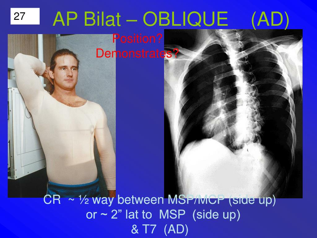 PPT - PA -anterior side BEST SEEN AP -posterior side BEST SEEN ...