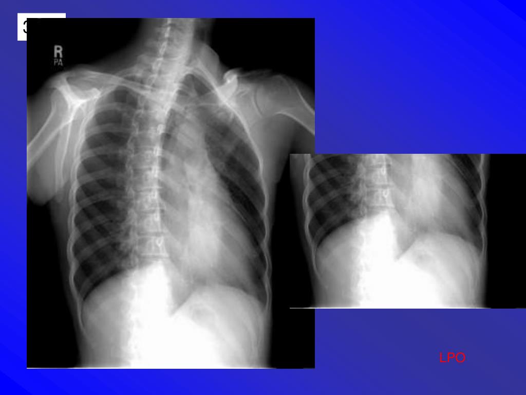 PPT - PA -anterior side BEST SEEN AP -posterior side BEST SEEN ...