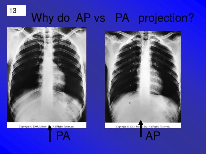 PPT - PA -anterior side BEST SEEN AP -posterior side BEST SEEN ...