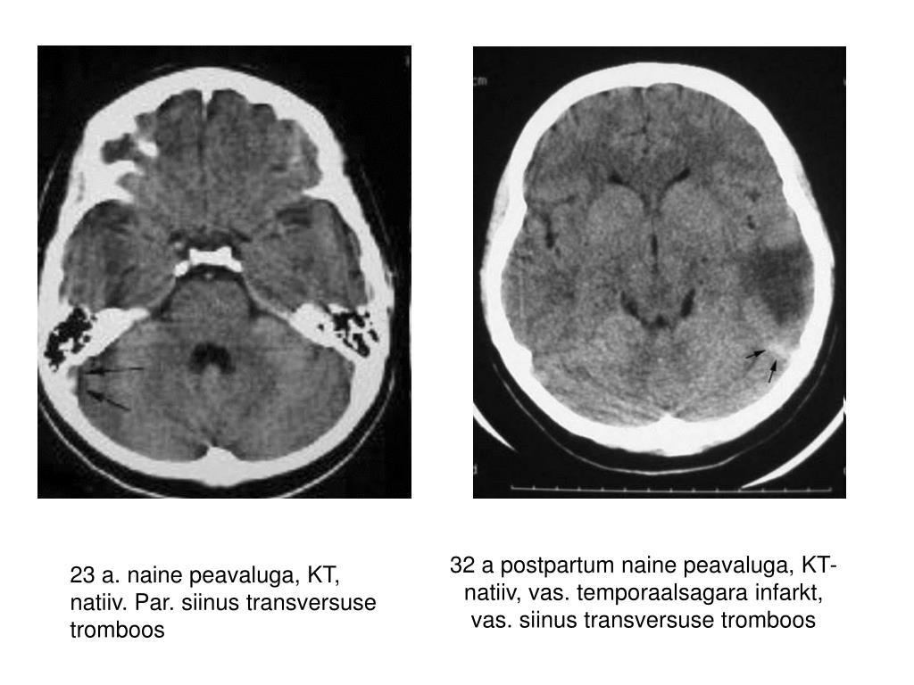 PPT - Aju venoossete siinuste tromboos PowerPoint Presentation, free ...