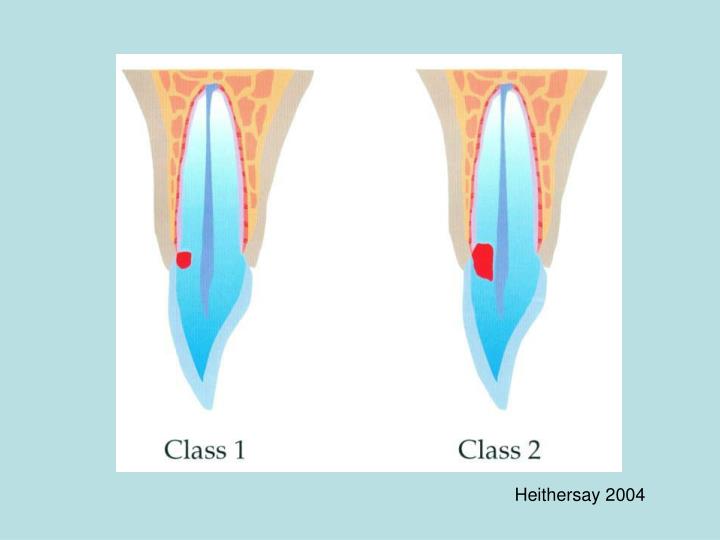 PPT - Resorpsjoner og reaksjoner PowerPoint Presentation - ID:3423923