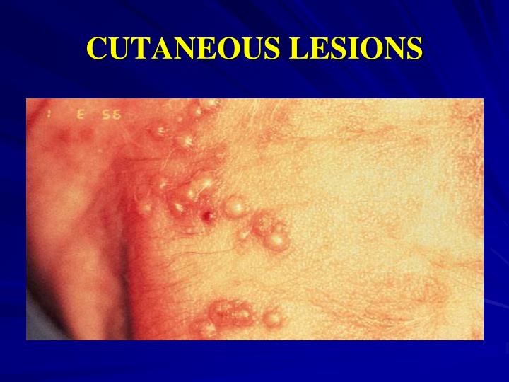 PPT - Neonatal Herpes Simplex Infection PowerPoint Presentation - ID ...