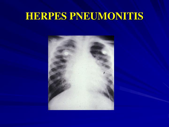PPT - Neonatal Herpes Simplex Infection PowerPoint Presentation - ID ...
