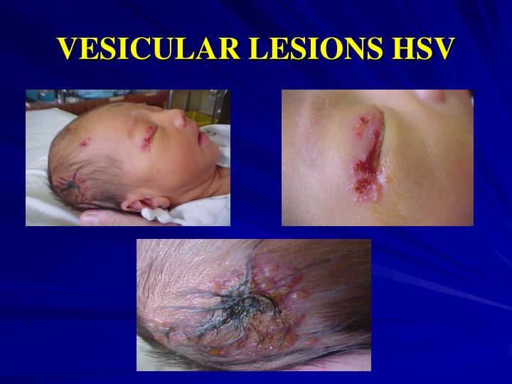 Ppt Neonatal Herpes Simplex Infection Powerpoint Presentation Id 9227