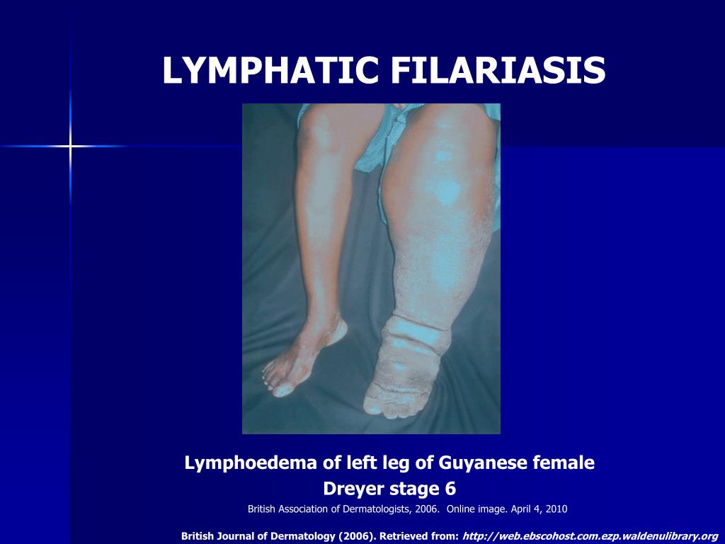 PPT - LYMPHATIC FILARIASIS A MAJOR PUBLIC HEALTH CHALLENGE IN THE 21ST ...