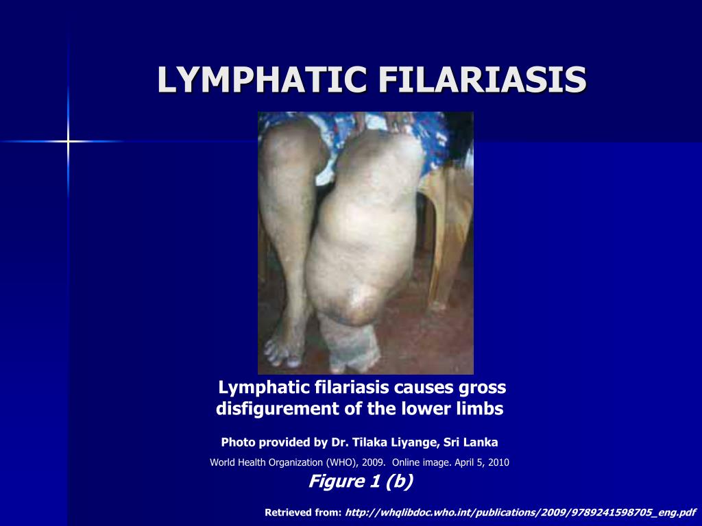 PPT - LYMPHATIC FILARIASIS A MAJOR PUBLIC HEALTH CHALLENGE IN THE 21ST ...