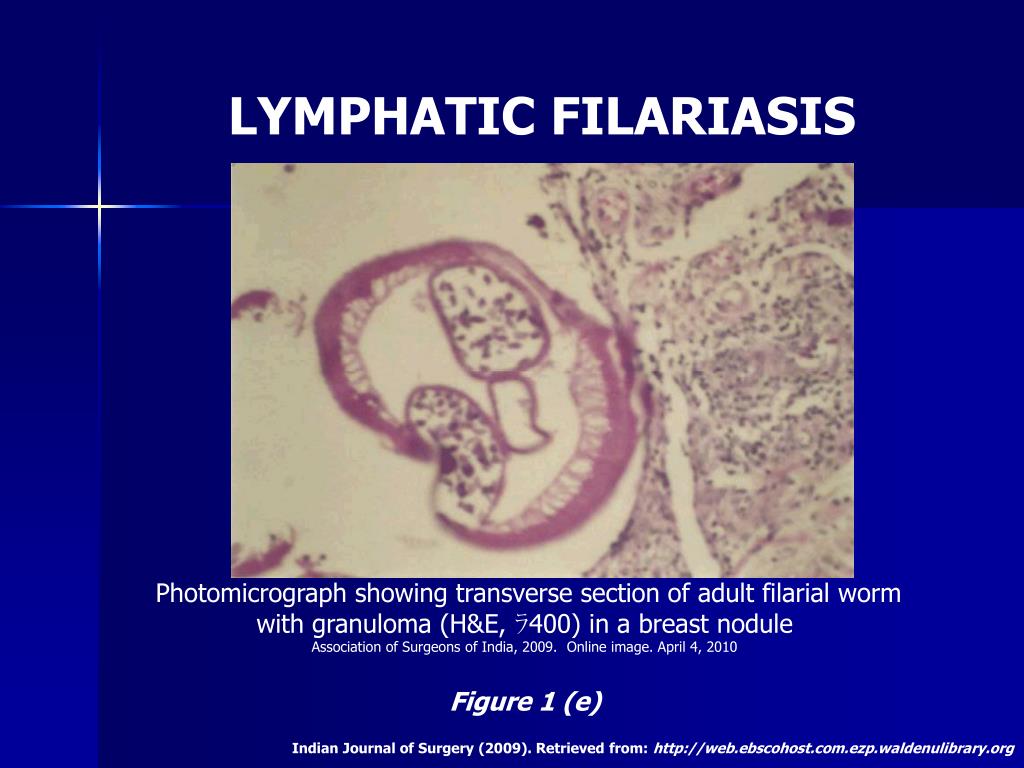 PPT - LYMPHATIC FILARIASIS A MAJOR PUBLIC HEALTH CHALLENGE IN THE 21ST ...