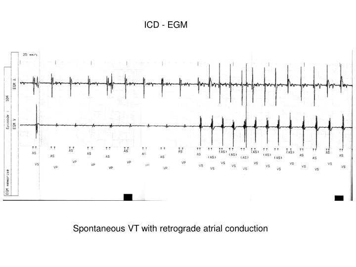 PPT - ICD - EGM PowerPoint Presentation, free download - ID:3429266