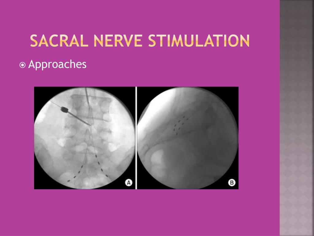 PPT - Interventional Approaches to pelvic pain in women PowerPoint ...
