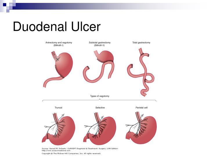 PPT - GERD and Peptic ulcer disease PowerPoint Presentation - ID:3429968