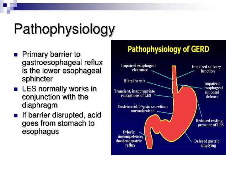 PPT - GERD and Peptic ulcer disease PowerPoint Presentation - ID:3429968