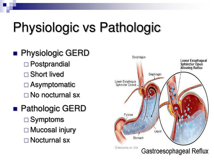 PPT - GERD and Peptic ulcer disease PowerPoint Presentation - ID:3429968