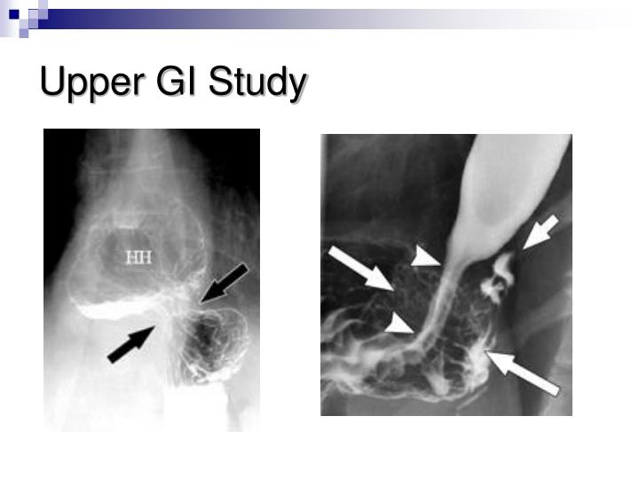 PPT - GERD and Peptic ulcer disease PowerPoint Presentation - ID:3429968