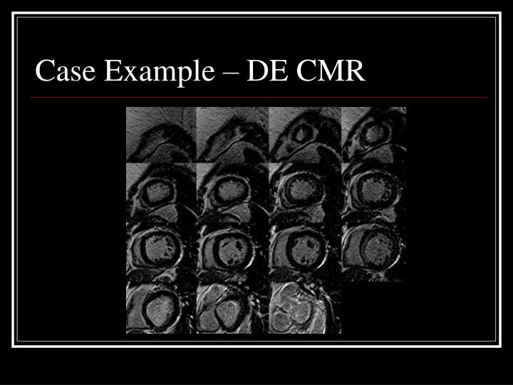 PPT - CMR of Non-ischemic Dilated and Restrictive Cardiomyopathies ...