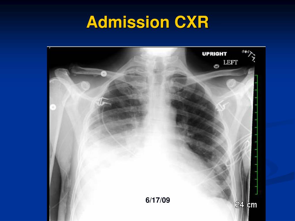 PPT - Endocarditis: A Plague for the 21 st Century? PowerPoint ...
