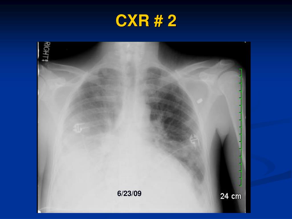 PPT - Endocarditis: A Plague for the 21 st Century? PowerPoint ...