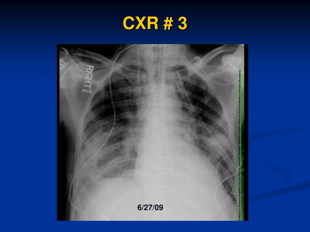 PPT - Endocarditis: A Plague for the 21 st Century? PowerPoint ...