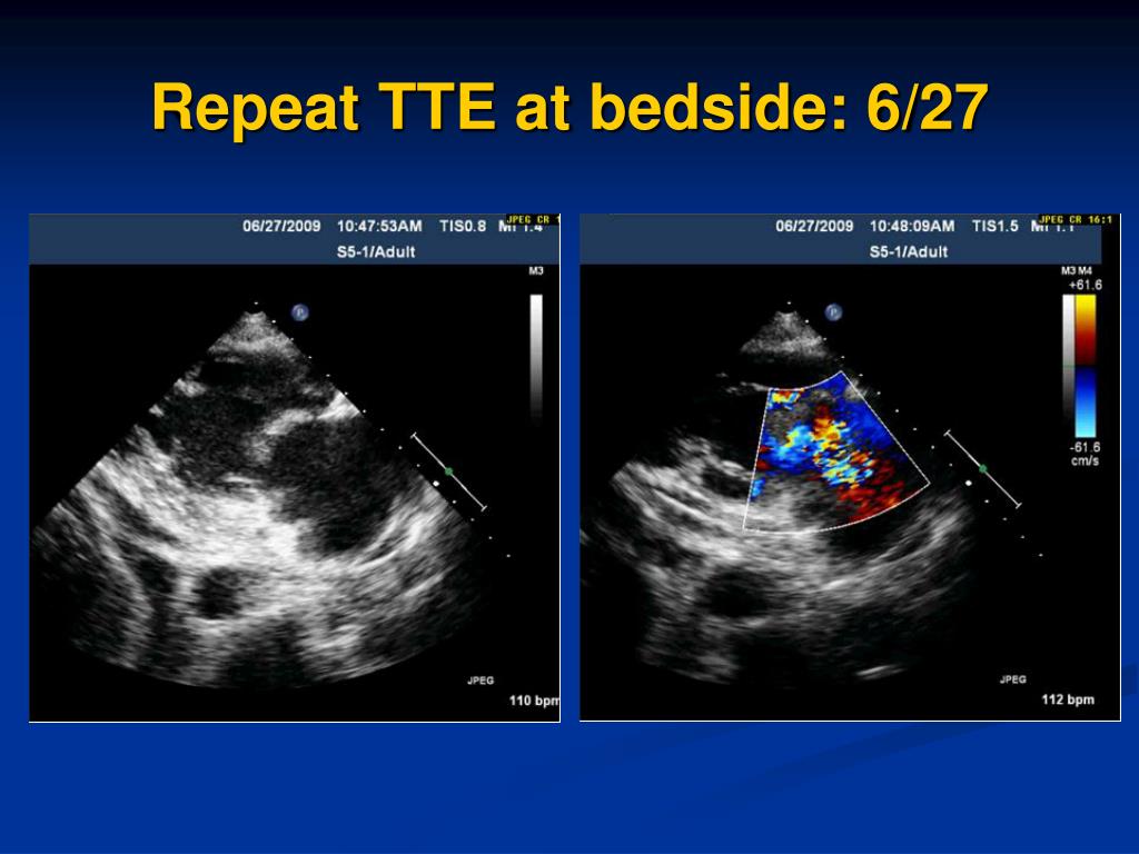 PPT - Endocarditis: A Plague for the 21 st Century? PowerPoint ...