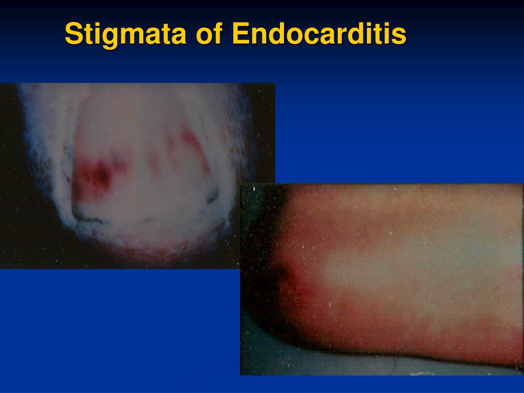 PPT - Endocarditis: A Plague for the 21 st Century? PowerPoint ...