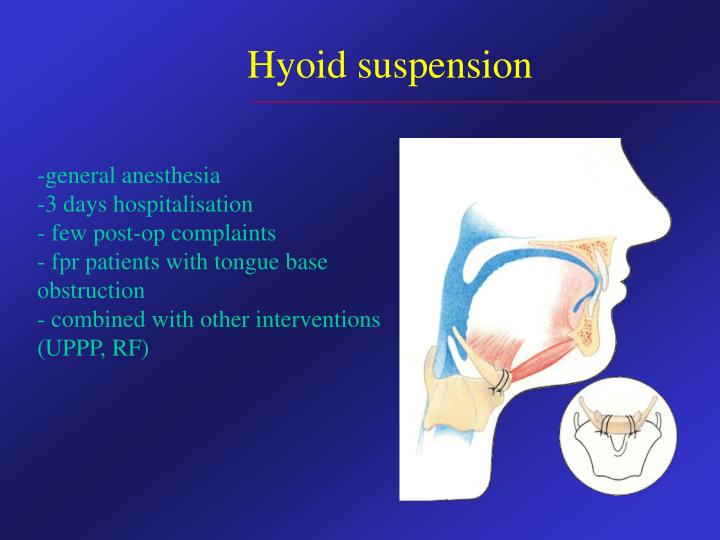 PPT - Experimental treatments for OSA PowerPoint Presentation - ID:3430856