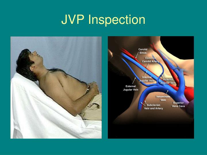 PPT - Jugular Venous Pulse PowerPoint Presentation - ID:3431335