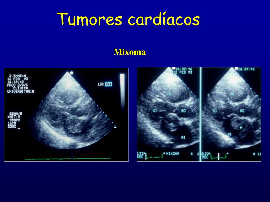 PPT - EL CORAZON EN LAS ENFERMEDADES SISTEMICAS Y EL EMBARAZO. TUMORES ...