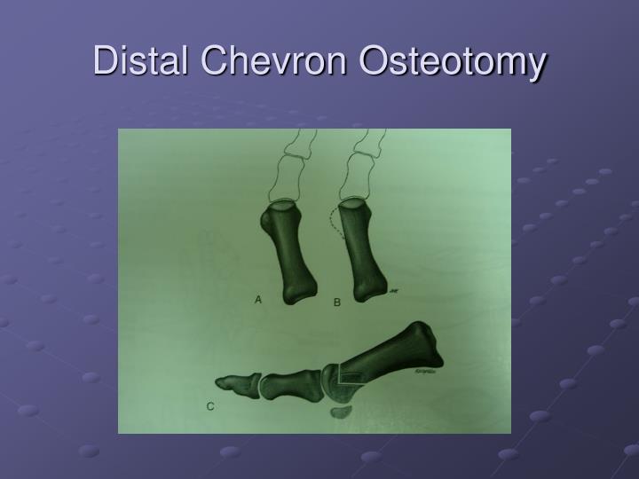 PPT - Hallux Valgus ( Bunion ) PowerPoint Presentation - ID:3432017