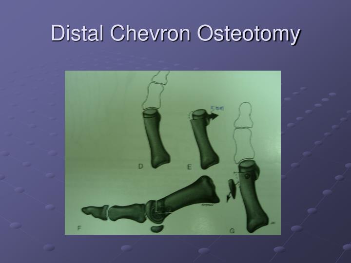 PPT - Hallux Valgus ( Bunion ) PowerPoint Presentation - ID:3432017