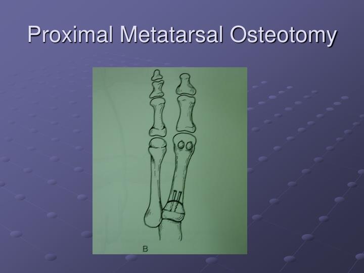 PPT - Hallux Valgus ( Bunion ) PowerPoint Presentation - ID:3432017