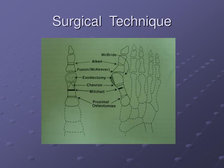 PPT - Hallux Valgus ( Bunion ) PowerPoint Presentation - ID:3432017
