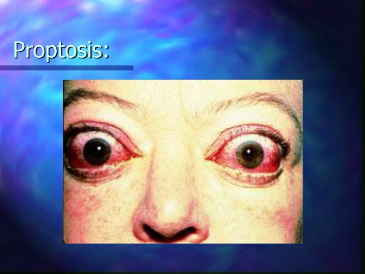 PPT - Thyroid Eye Disease & Other Orbital Conditions PowerPoint ...