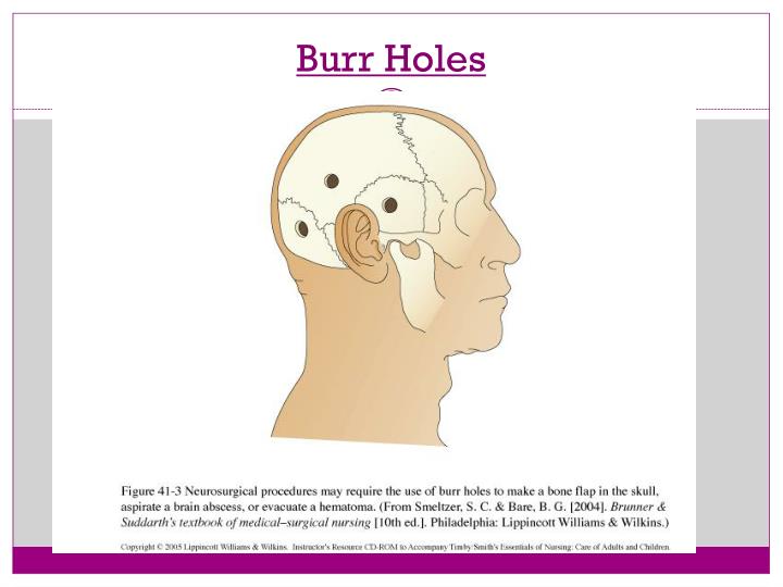 PPT - Traumatic Brain Injury (TBI) PowerPoint Presentation - ID:3435952