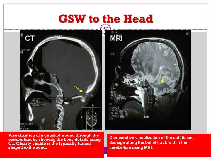 PPT - Traumatic Brain Injury (TBI) PowerPoint Presentation - ID:3435952