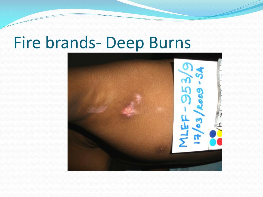 PPT - Child abuse or Non-accidental Injury (NAI) in Children PowerPoint ...