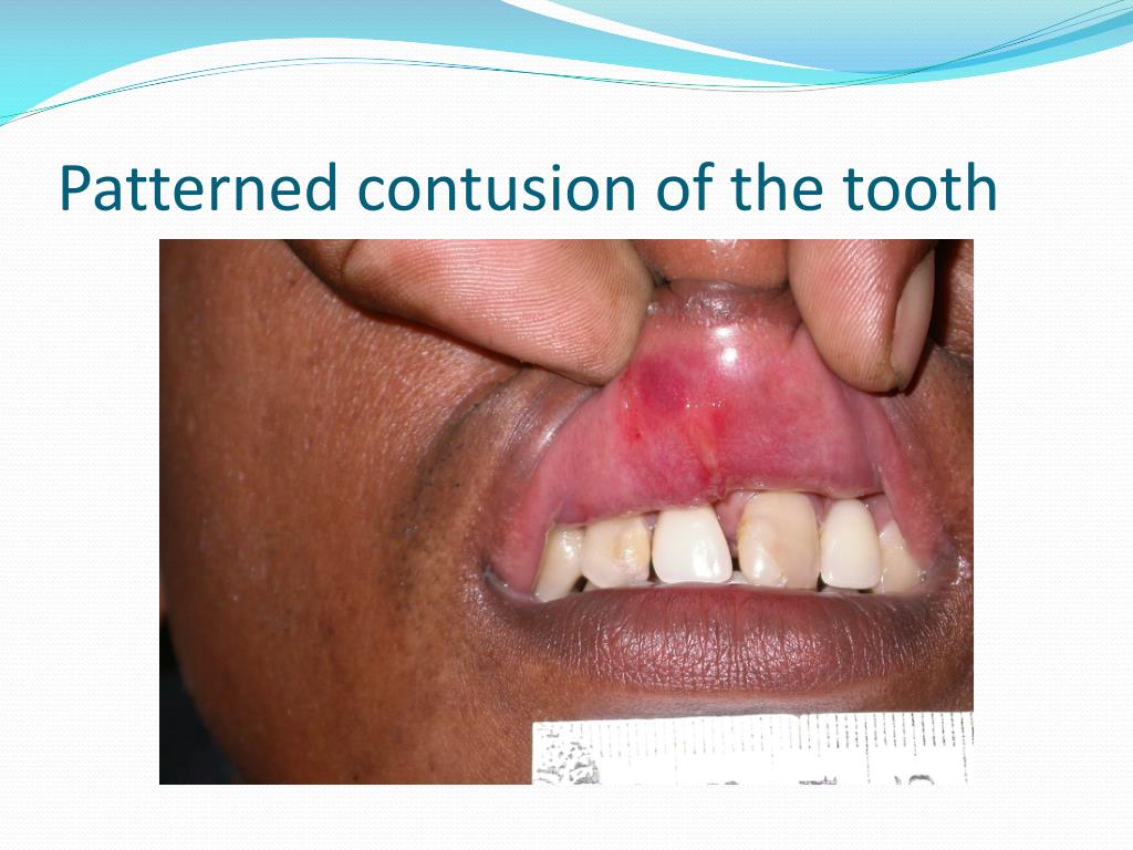 PPT - Child abuse or Non-accidental Injury (NAI) in Children PowerPoint ...