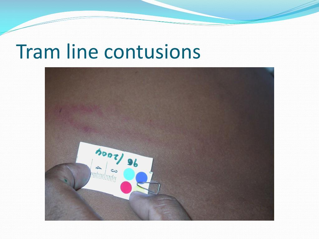 PPT - Child abuse or Non-accidental Injury (NAI) in Children PowerPoint ...