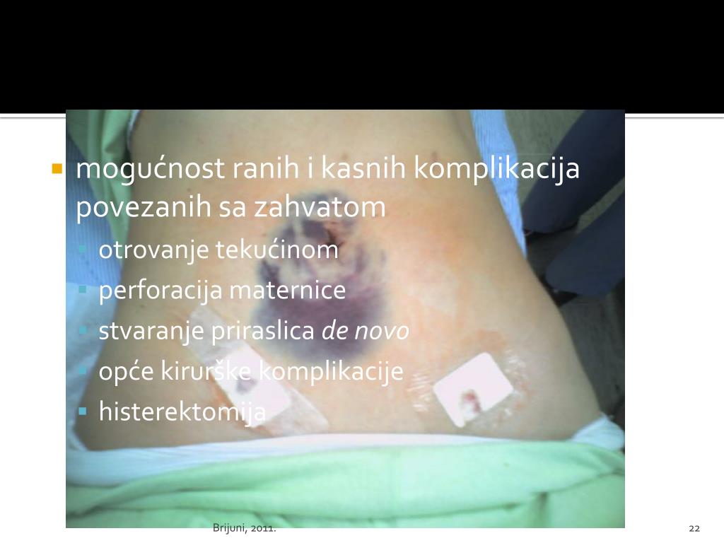 PPT - Je li miomektomija obavezna priprema za IVF ? PowerPoint ...