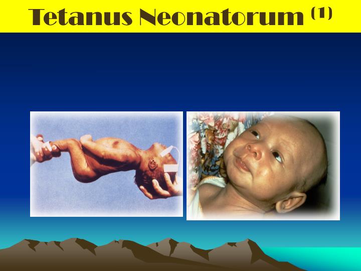 PPT - SURVEILANS TETANUS NEONATORUM PowerPoint Presentation - ID:3454980