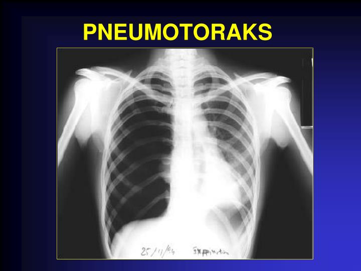 PPT - PEMERIKSAAN SPIROMETRI PowerPoint Presentation - ID:3456092