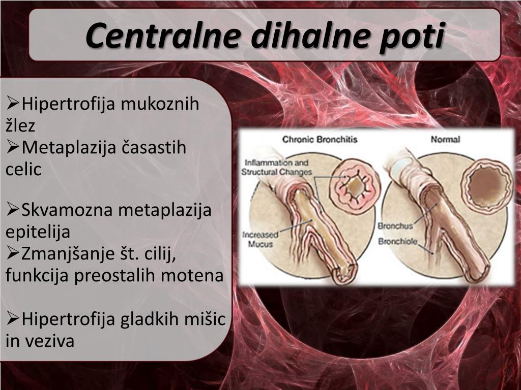 PPT - KOPB Kronična Obstruktivna Pljučna Bolezen PowerPoint ...