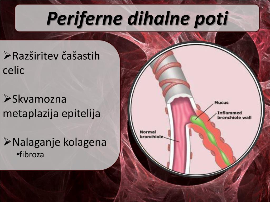 PPT - KOPB Kronična Obstruktivna Pljučna Bolezen PowerPoint ...